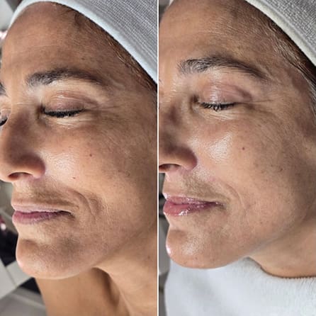 Non-Surgical Skin Lifting | Dermure Regenerative Skin & Laser